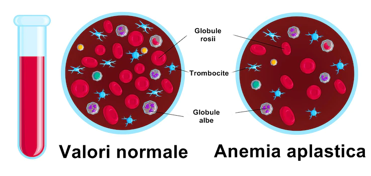 Anemia aplastică – cauze, simptome, diagnostic și tratament - Asociatia ...
